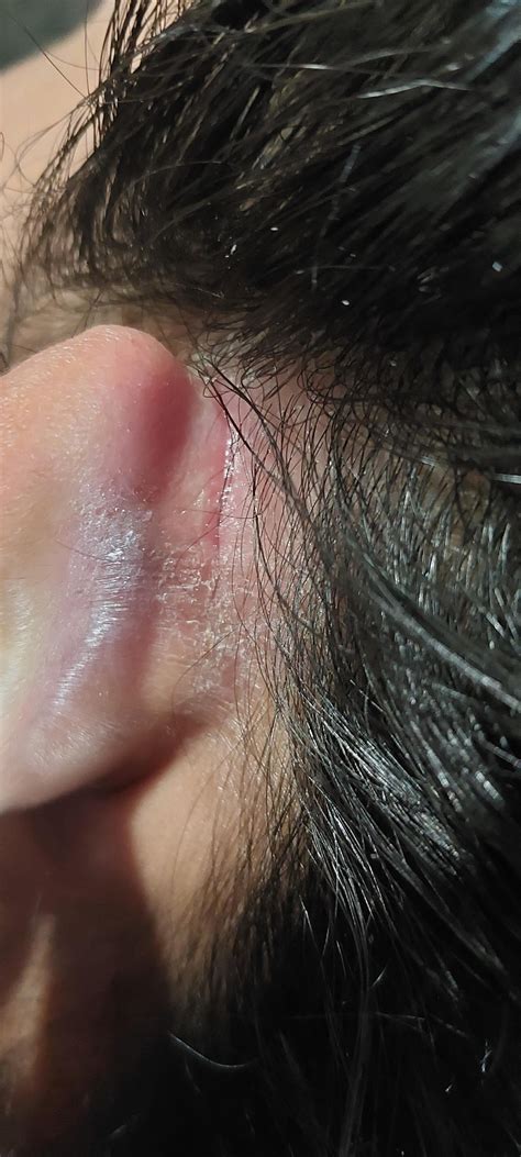 Behind Ears Issue Rsebderm