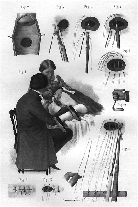 Cesarean Section A Brief History Part 3