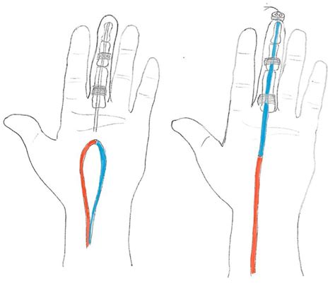 Reconstruction Of Tendon Losses