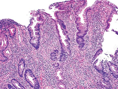 Non Neoplastic Disorders Of The Colon Clinical Tree