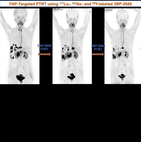 Fap Targeted Radiopeptide Therapy Using 177lu 225ac And 90y Labeled