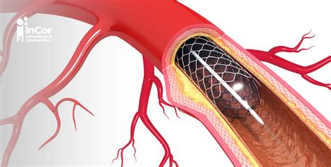 Short Dapt Com Clopidogrel Após Icp Portal Triple I