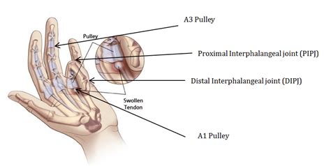Trigger Finger Causes Symptoms Treatment And Exercises Rebalance Sports Medicine