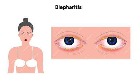 Premium Vector Blepharitis Eye Disease Ophthalmology Inflamed Sick