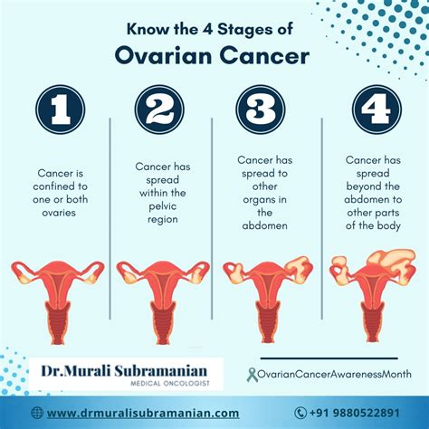Ppt 4 Stages Of Ovarian Cancer Best Medical Oncologist In Kalyan