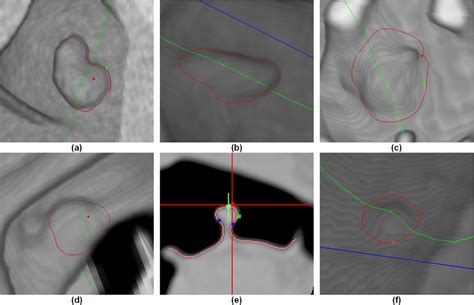 illustrative examples of polyp segmentation in computed tomography