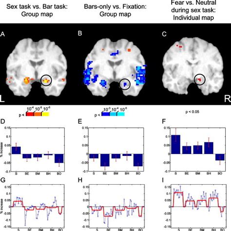 A Group Map Of The Contrast Of The Sex Task Vs Bar Orientation Task