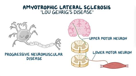 Video Amyotrophic Lateral Sclerosis Als Nursing Osmosis