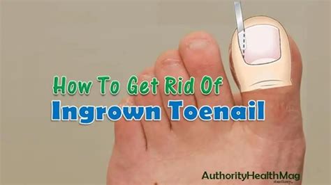 How To Get Rid Of An Ingrown Toenail Without Surgery At Thomas Lintz Blog
