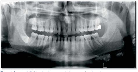 Calcification Of Lymph Nodes