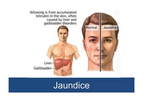 Laboratory Approach To Jaundice Pptx