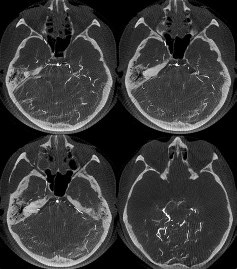 Trigeminal Artery
