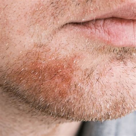 Seborrheic Dermatitis Treatment Effective Solutions For Scalp And Skin