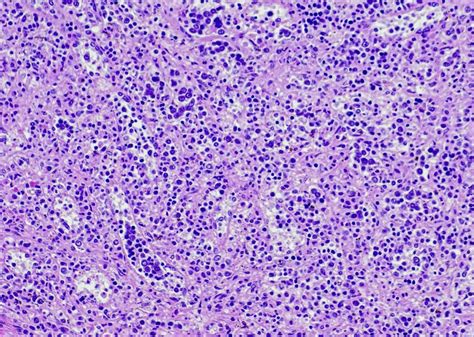 Manifest 2 Results Support “paradigm Shift” In Myelofibrosis Treatment