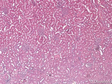 Angiomyolipoma Of Uterus