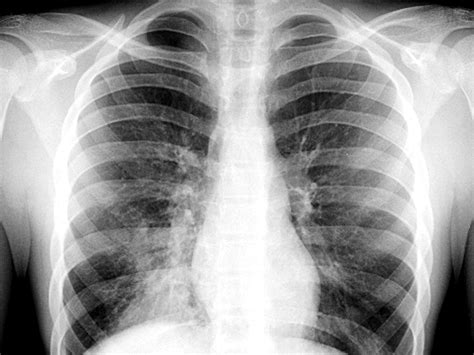 Xanthosis Definition Xanthosis Definition