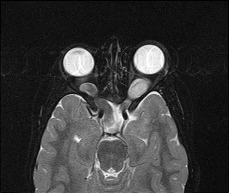 Optic Nerve Glioma