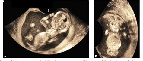 Anencephaly 3d Ultrasound