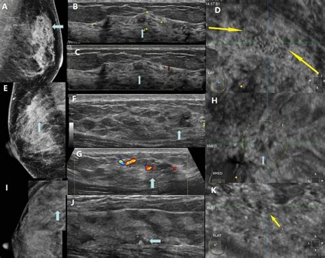 A D 46y Female A Patchy Distribution Of Amorphous Calcification In