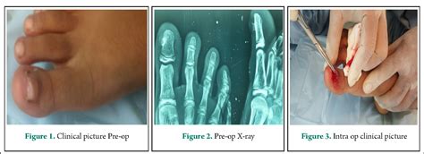 Figure 1 From Osteochondroma Of Great Toe A Rare Presentation
