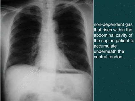 Pneumoperitoneum X Ray Pptx