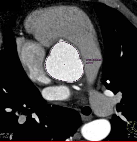 Central Line Mapping Of A Dilated Ascending Aorta Cardiac Radiology