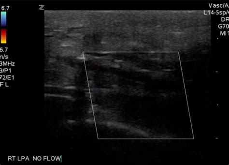Cholesterol Embolization After Lower Extremity Revascularization