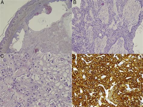 Histopathology A Well Defined Nonencapsulated Dermal Hypodermal