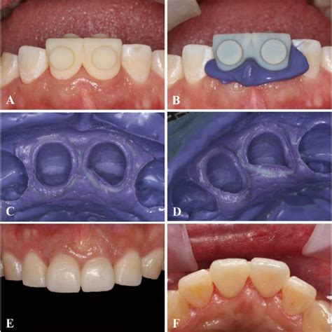The Impression Taking Procedure With Individual Tooth Tray A Try In
