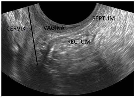 Transvaginal Ultrasound Cervix