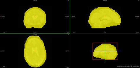 Freesurfer汉化教程mpr2mni305 Csdn博客