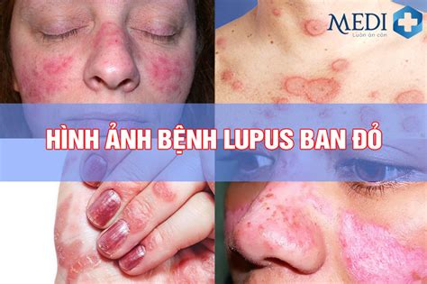 Lupus Ban Do Sale Online Emergencydentistry Com