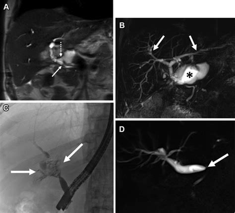 Imaging Of Ischemic Cholangiopathy Following Donation After Circulatory Death Liver Transplant