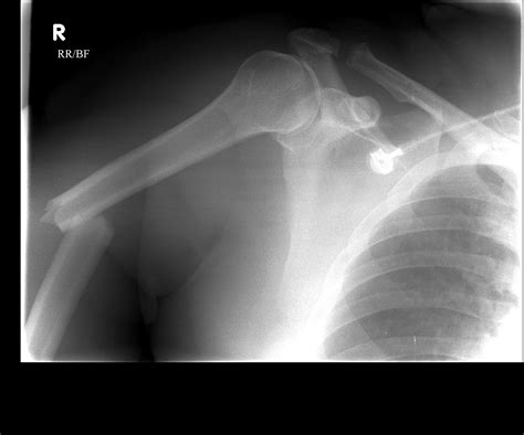 What Are The Symptoms Of A Fractured Humerus At Martha Brugger Blog