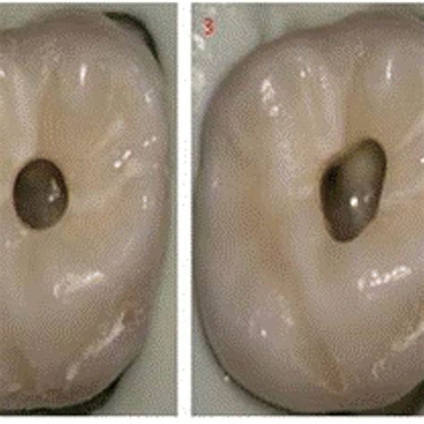 Pdf Evaluation Of Relationship Between Endodontic Access Cavity Types And Secondary