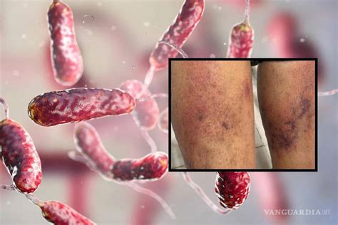 Eu En Alerta Por Bacteria ‘devoradora De Carne En El Golfo De México