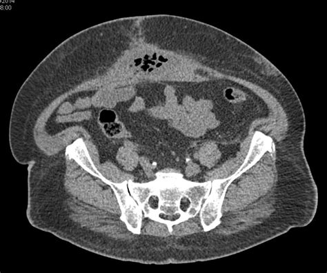 Peritoneal Abscess Appendix