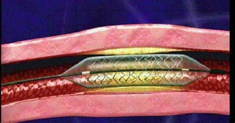 파열 위험 높은 ‘취약성 동맥경화 스텐트 시술로 예방하면 안전