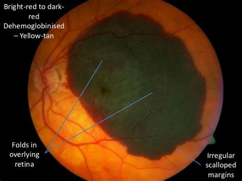 Subretinal Hemorrhage Subretinal Hemorrhage