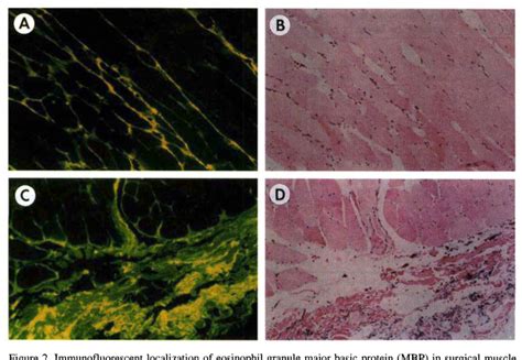 Figure 2 From Myiasis Due To Hypoderma Lineatum Infection Mimicking The