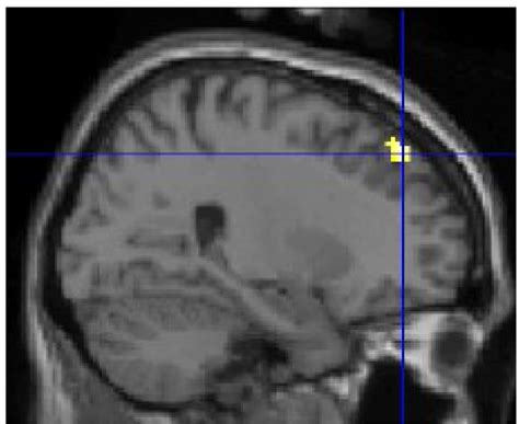 Figure 2 From Abnormalities Of Intrinsic Functional Connectivity In