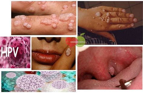 Hpv Papilomavírus Humano Causas Sintomas E Tratamentos Dicas De