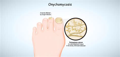 Nail Onychomycosis Definition At Harry Leslie Blog