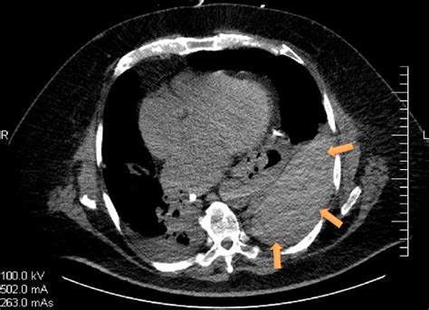 Left Sided Retained Post Traumatic Hemothorax Orange Arrows