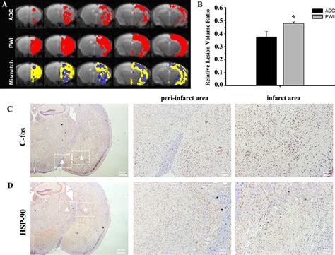 The Penumbra At One Hour After Occlusion On Mri A Representative Download Scientific Diagram