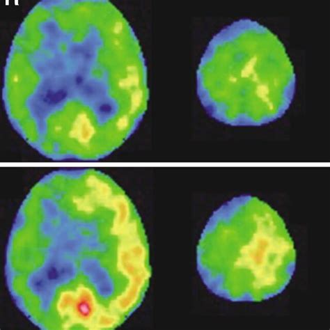Preoperative Brain Perfusion Single Photon Emission Computed Tomography