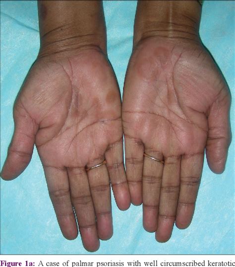 Psoriasis Palms Of Hands