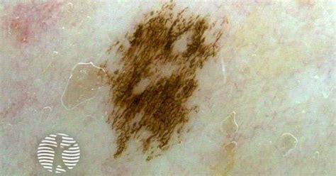 Dermoscopy Image