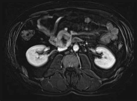 Duodenal Gist Body Mr Case Studies Ctisus Ct Scanning Duodenal Gist Body Mr Case Studies Ctisus Ct Scanning