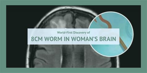 8cm Worm In Womans Brain